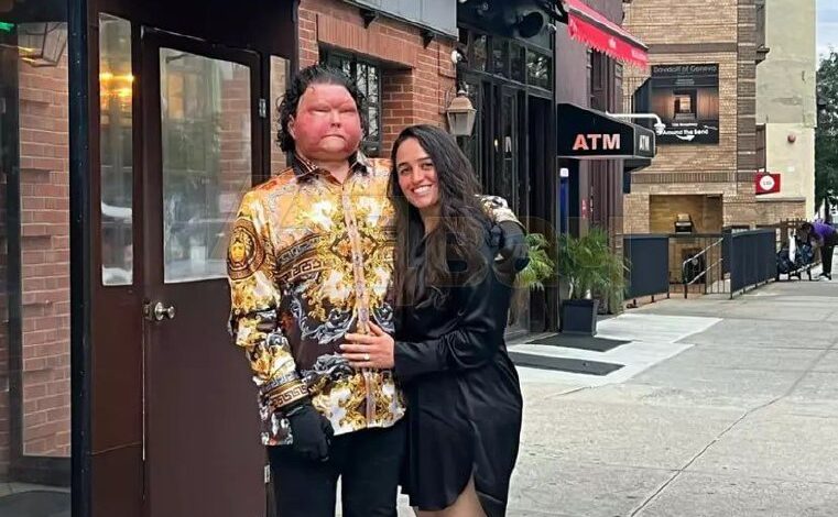 The man who underwent the world's first face transplant marries In 2018 ...